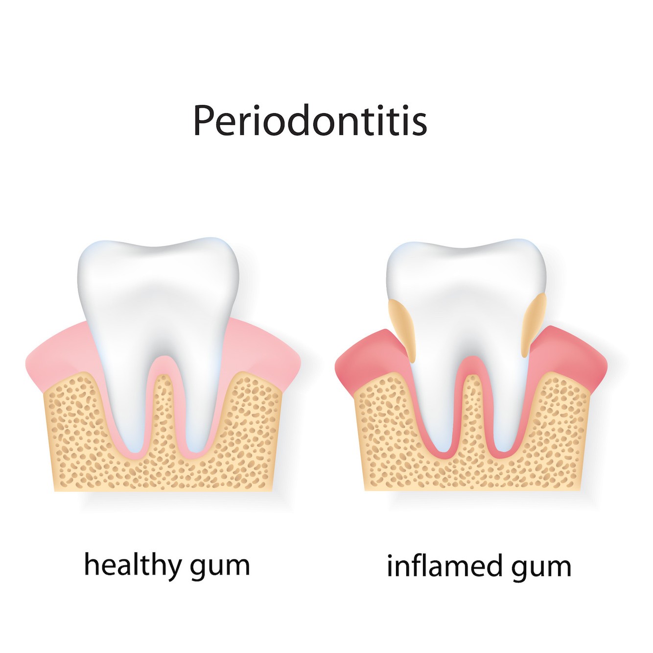 12 Tipps & 18 FAQs zu Parodontitis / Parodontose